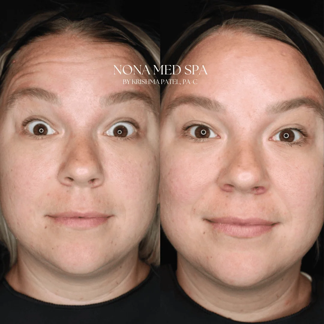 Before and After | Nona Med Spa